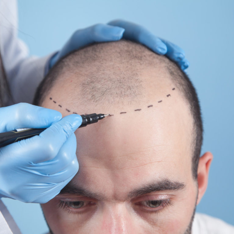 Zona Periocular - Clínicas Mets - Medicina Estética